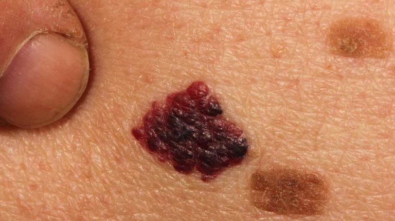 Angiomas: ¿qué son y por qué aparecen puntos rojos en la piel?