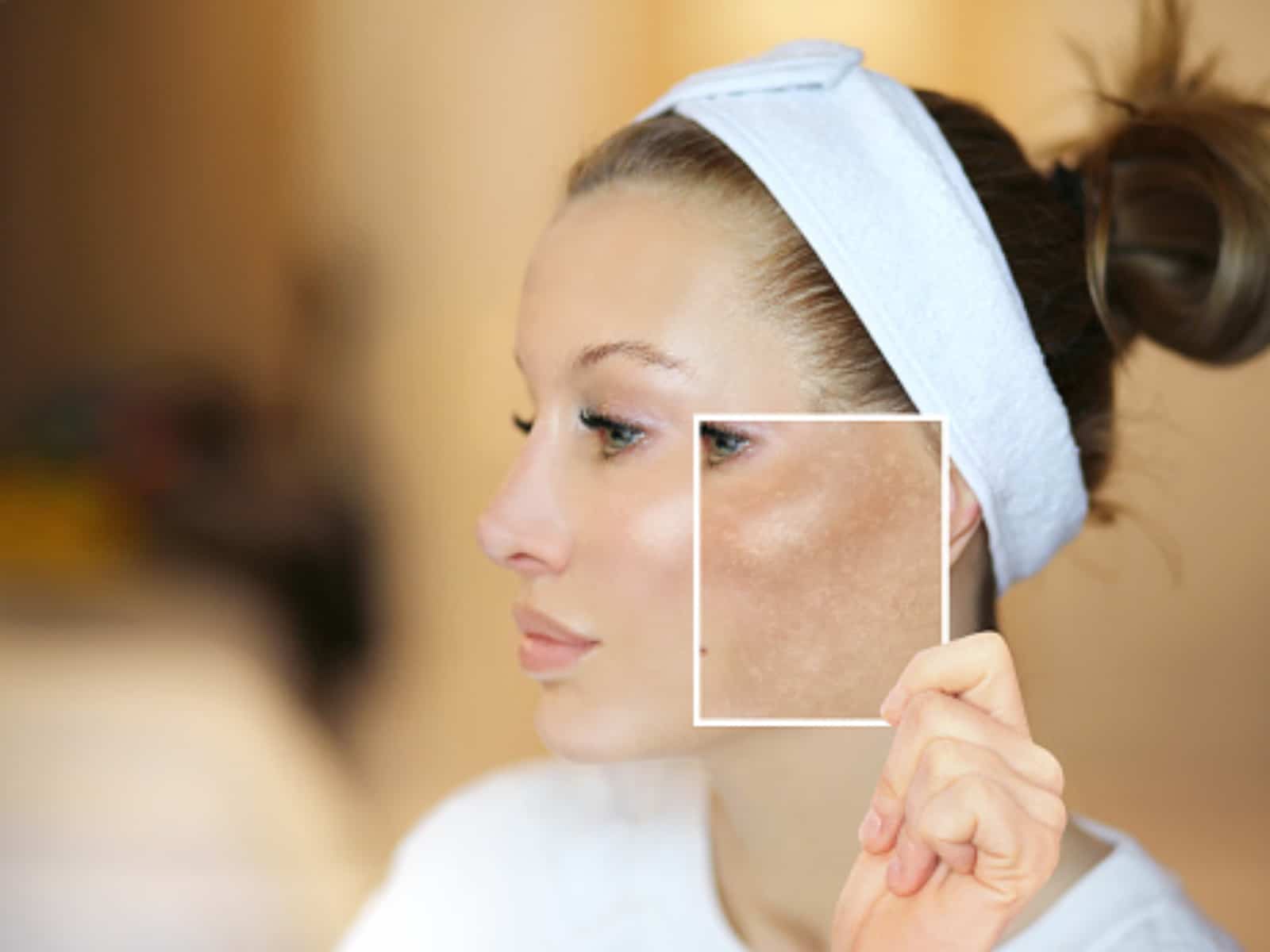 Melasma: ¿en qué consiste y cómo puede prevenirse?