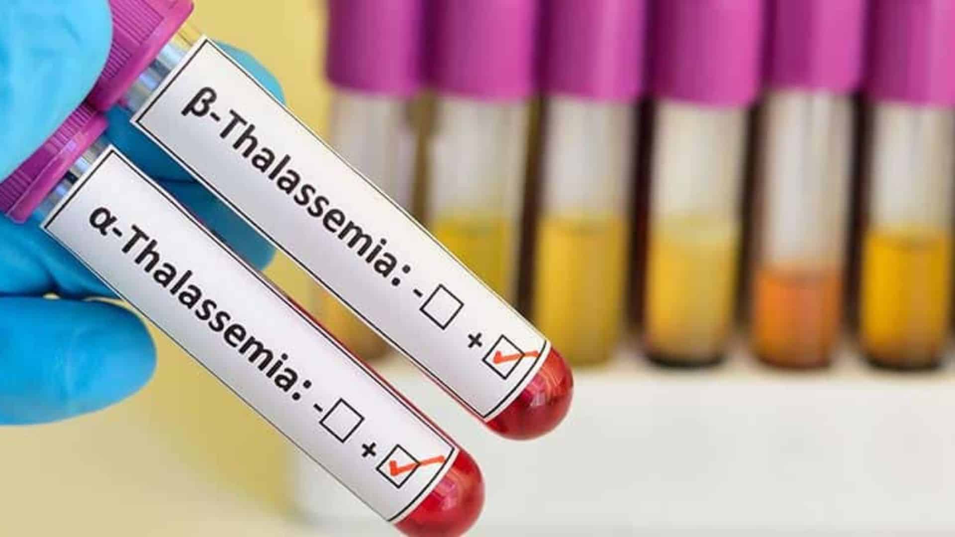 Qué es la talasemia: síntomas y tratamiento - El Diario Venezuela ...